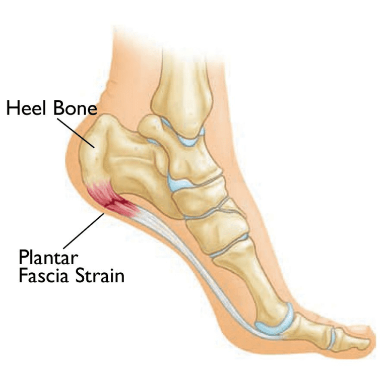 Heel Spurs vs Plantar Fasciitis: Key Differences Explained